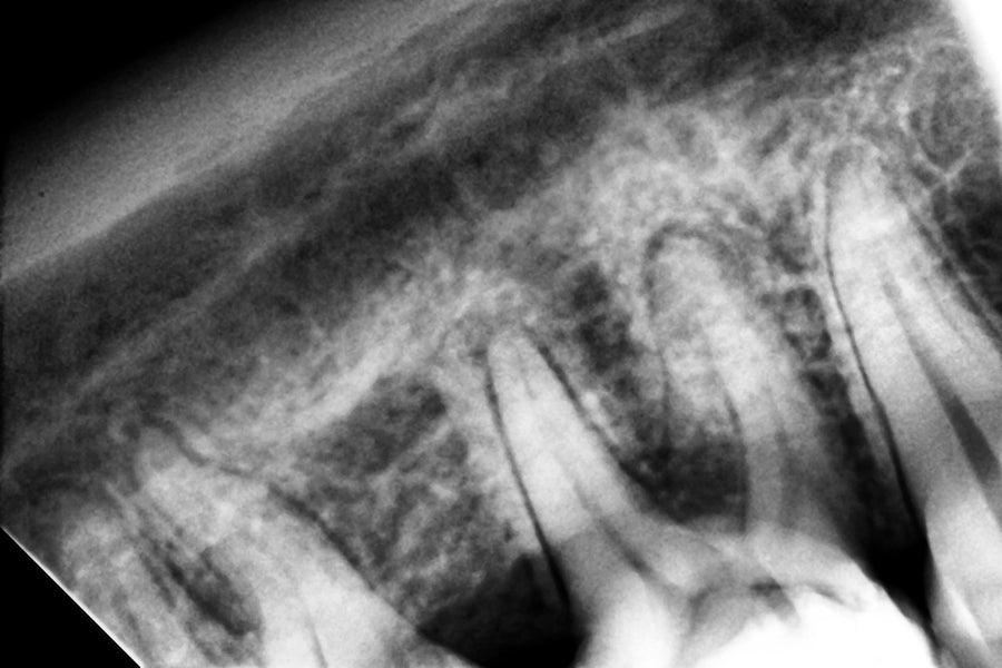 Woodpecker® i-Sensor Digital X-Ray Sensor