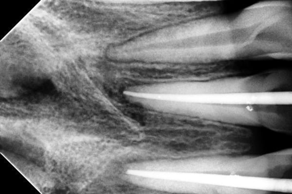 Woodpecker® i-Sensor Digital X-Ray Sensor