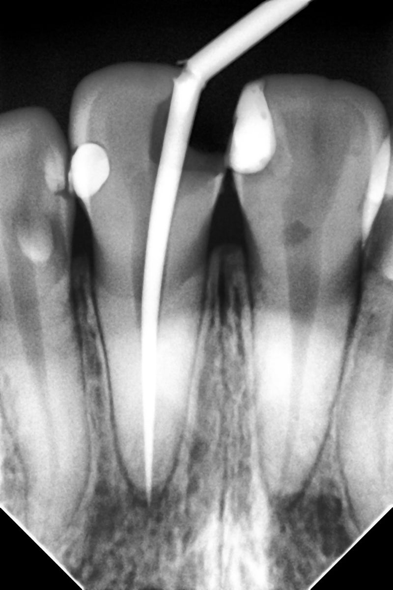 Woodpecker® i-Sensor Digital X-Ray Sensor